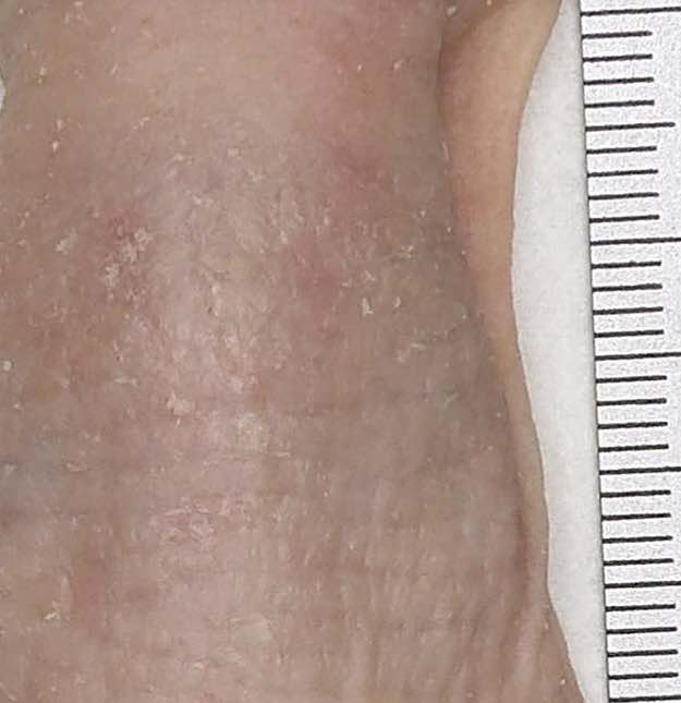 Rhino Mouse Acne Model / Imavita / Preclinical efficacy CRO