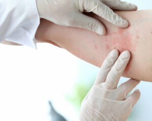 IL-23 induced Atopic Dermatitis Mouse Model • Imavita • CRO